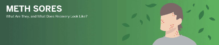 Meth Sores: What Are They, and What Does Methamphetamine Recovery Look ...